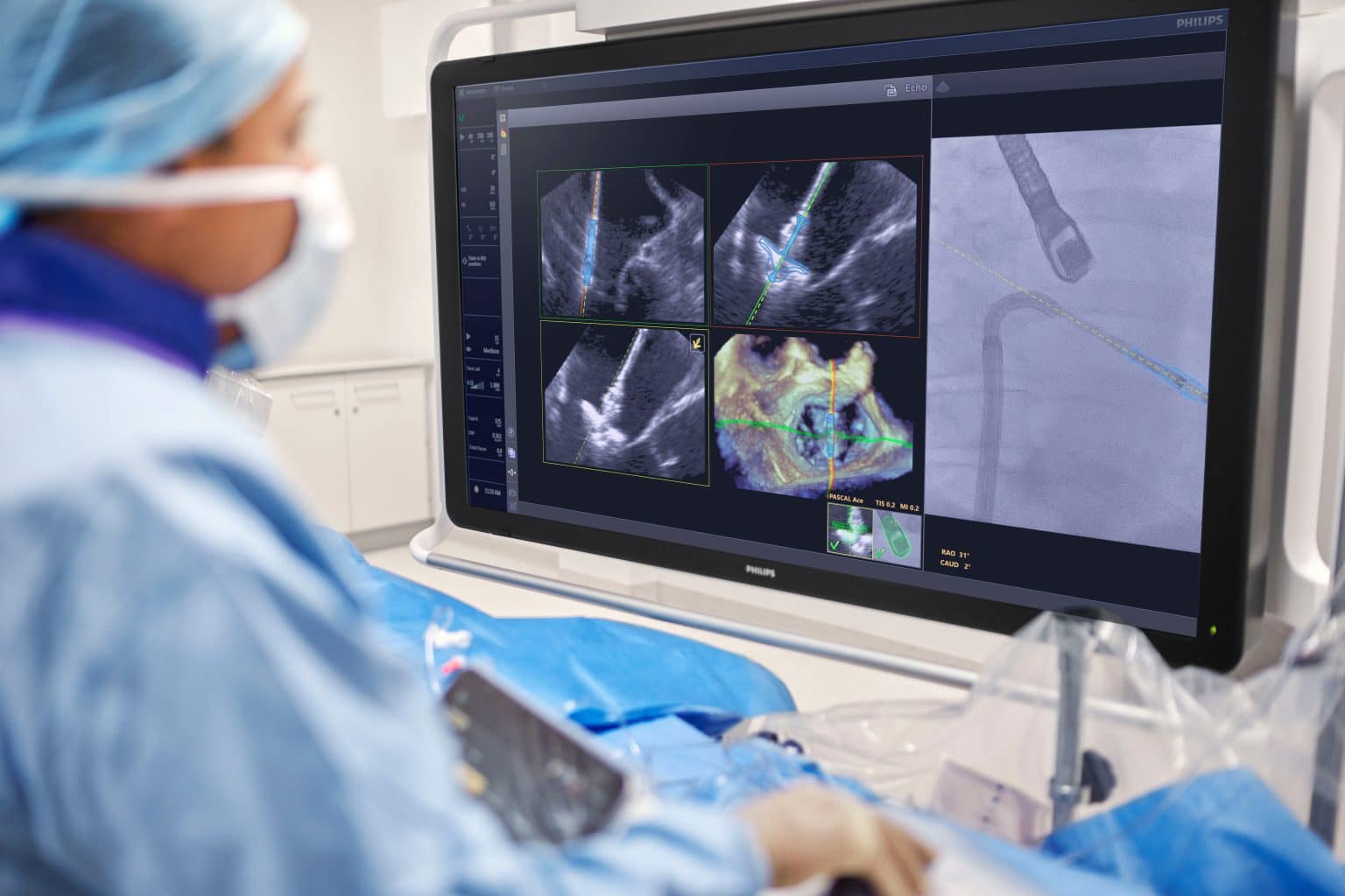 FDA Clears Philips AI Solution for Heart Valve Repair - TechNation